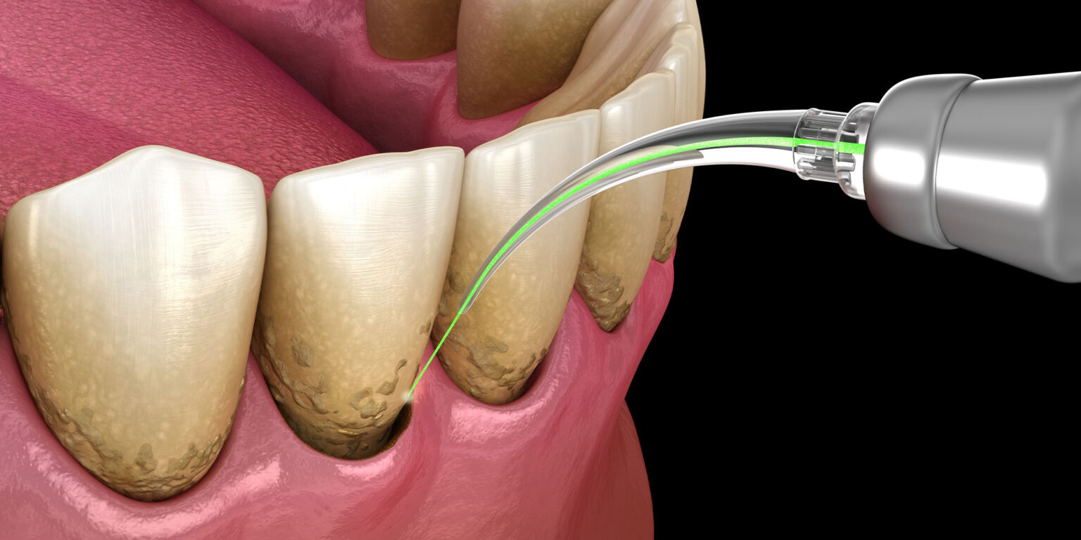 LANAP Laser Gum Surgery Bradenton & Sarasota FL | Minimally Invasive