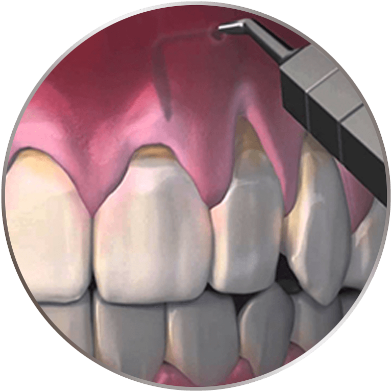 Pinhole Gum Recession Treatment | Bradenton & Sarasota FL | Minimally ...